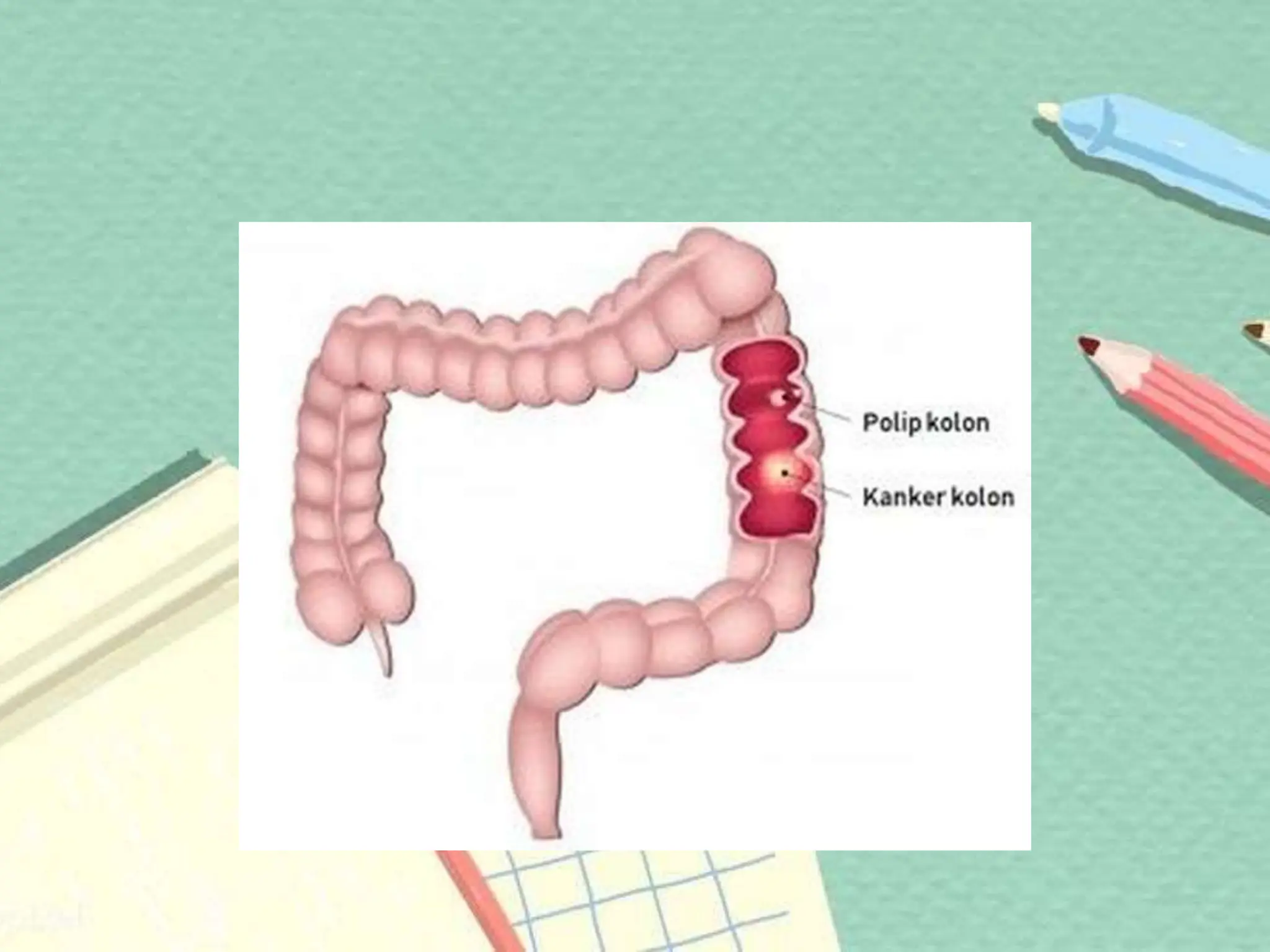 materi KANKER KOLON / kanker usus besar.pptx