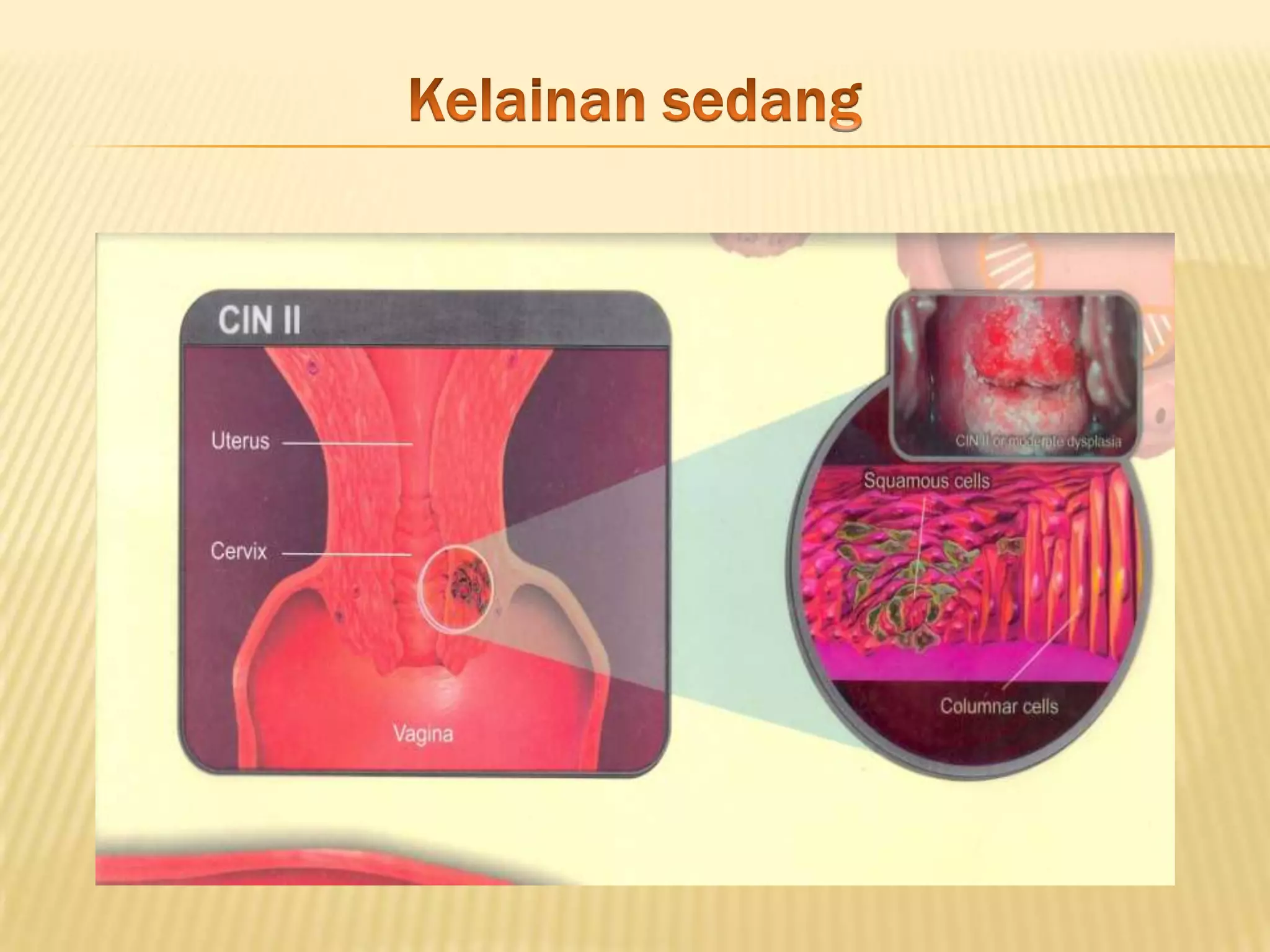 Kanker Leher Rahim dan Pencegahannya | PPTX