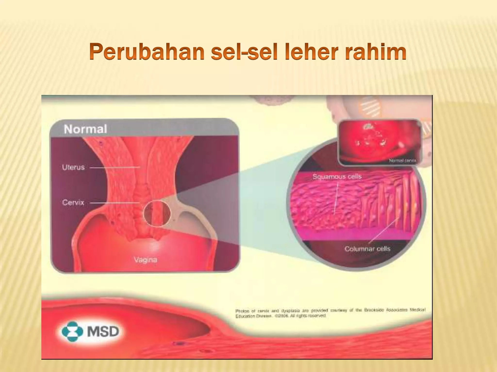 Kanker Leher Rahim dan Pencegahannya | PPTX