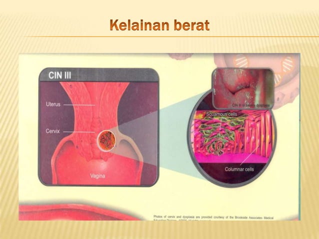 Kanker Leher Rahim dan Pencegahannya | PPTX