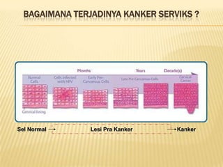 Kanker Leher Rahim dan Pencegahannya | PPTX