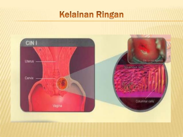Kanker Leher Rahim dan Pencegahannya | PPTX