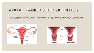 KANKER LEHER RAHIM mmmmmmmmmmmmmmmmmmmmmmm | PPTX