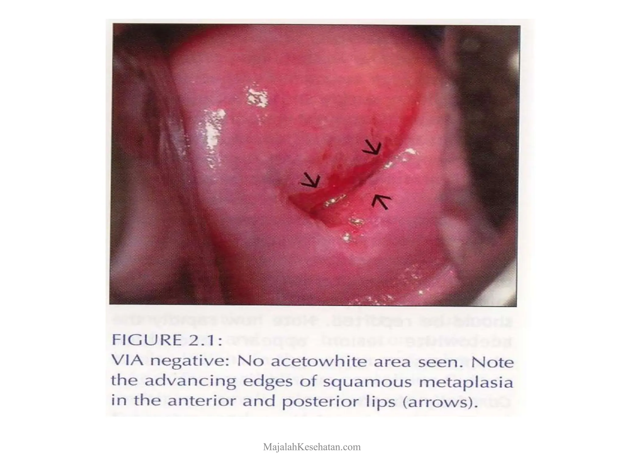 Konsep tata laksana Kanker Leher Rahim Papsmear & IVA.ppt