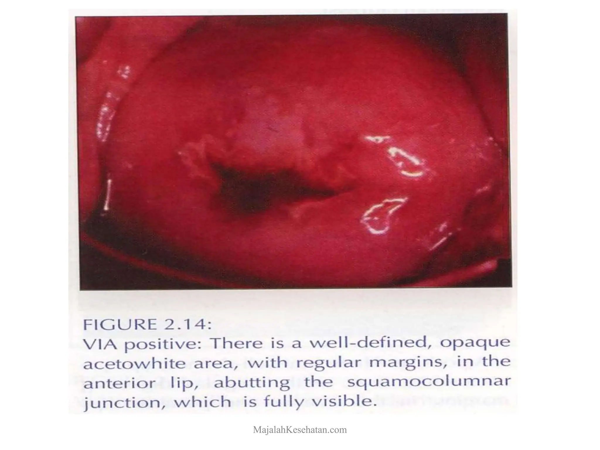 Konsep tata laksana Kanker Leher Rahim Papsmear & IVA.ppt