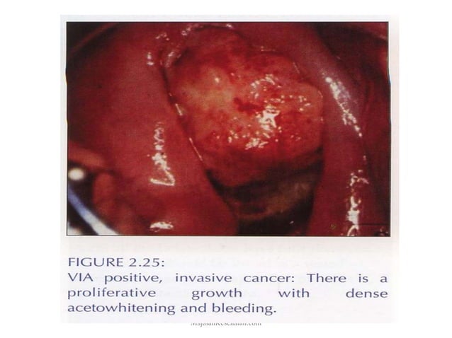 Konsep tata laksana Kanker Leher Rahim Papsmear & IVA.ppt
