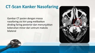 KANKER NASOFARING lecture ear nose throa | PPT | Free Download