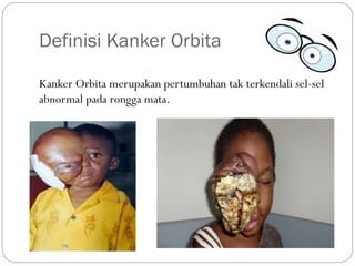 Kanker orbita | PPTX
