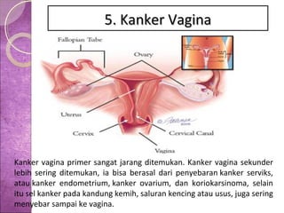Kanker Pada Sistem Reproduksi | PPT