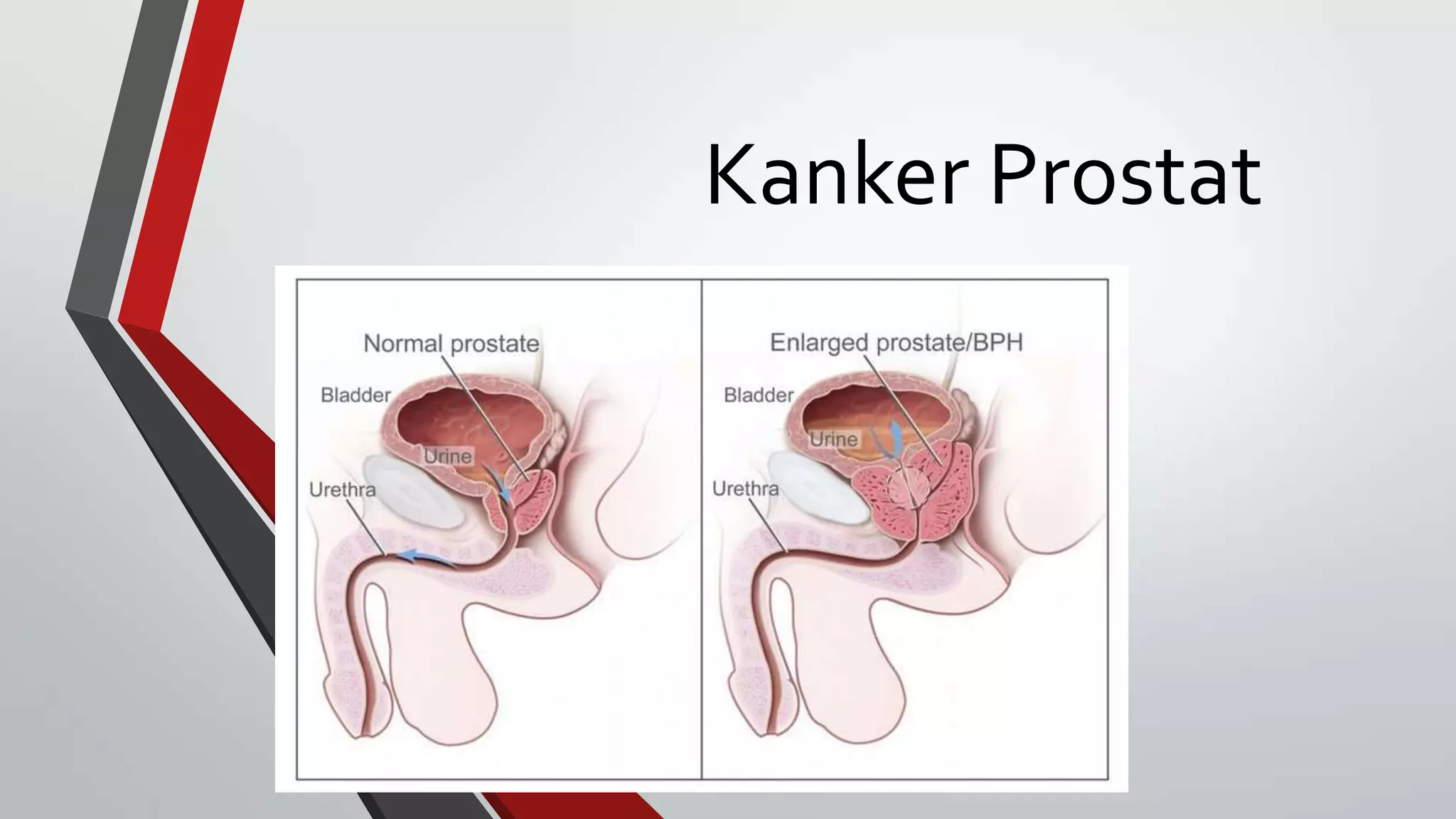 Kanker prostat | PPTX
