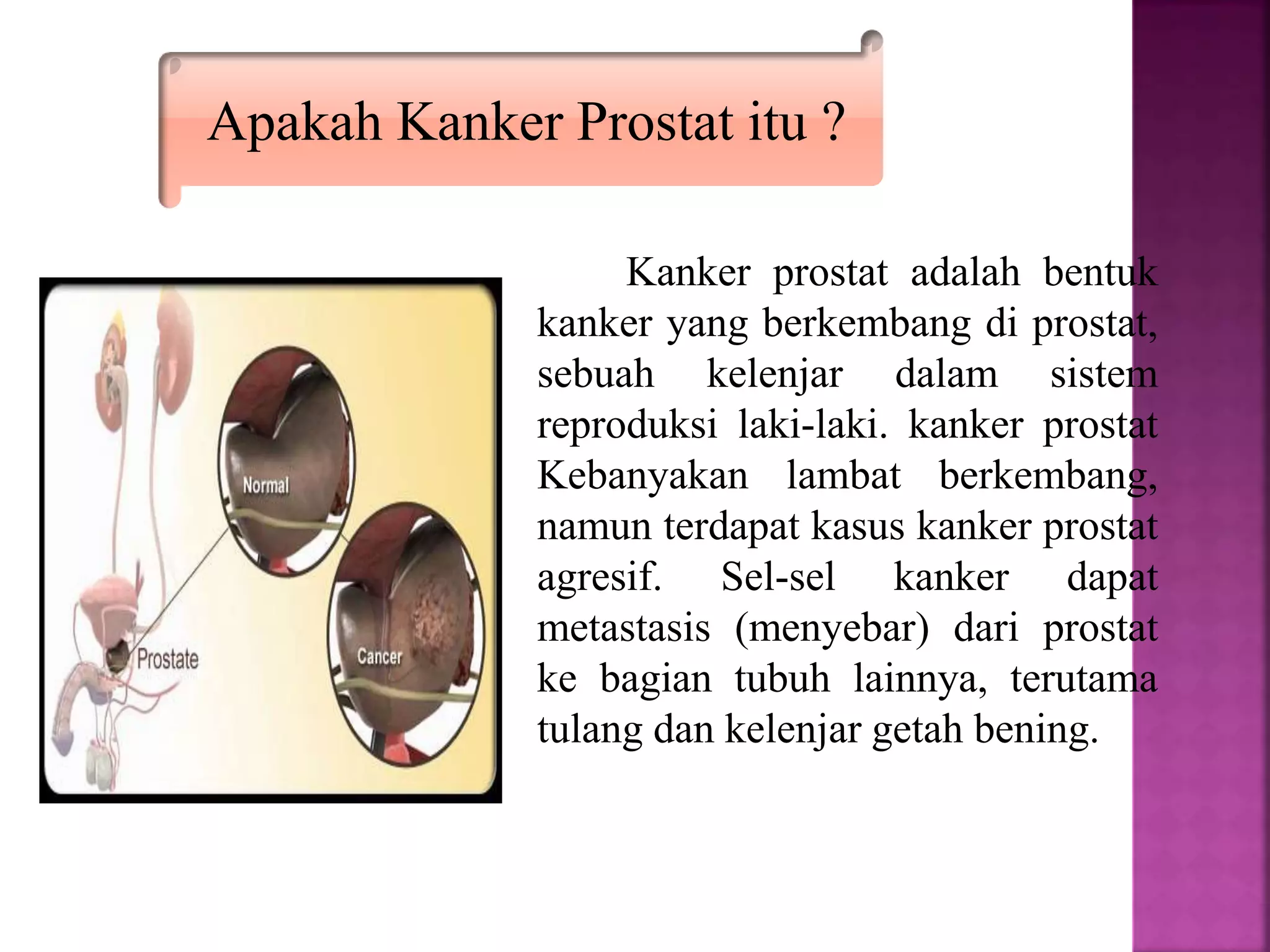 Kanker prostat power point | PPTX