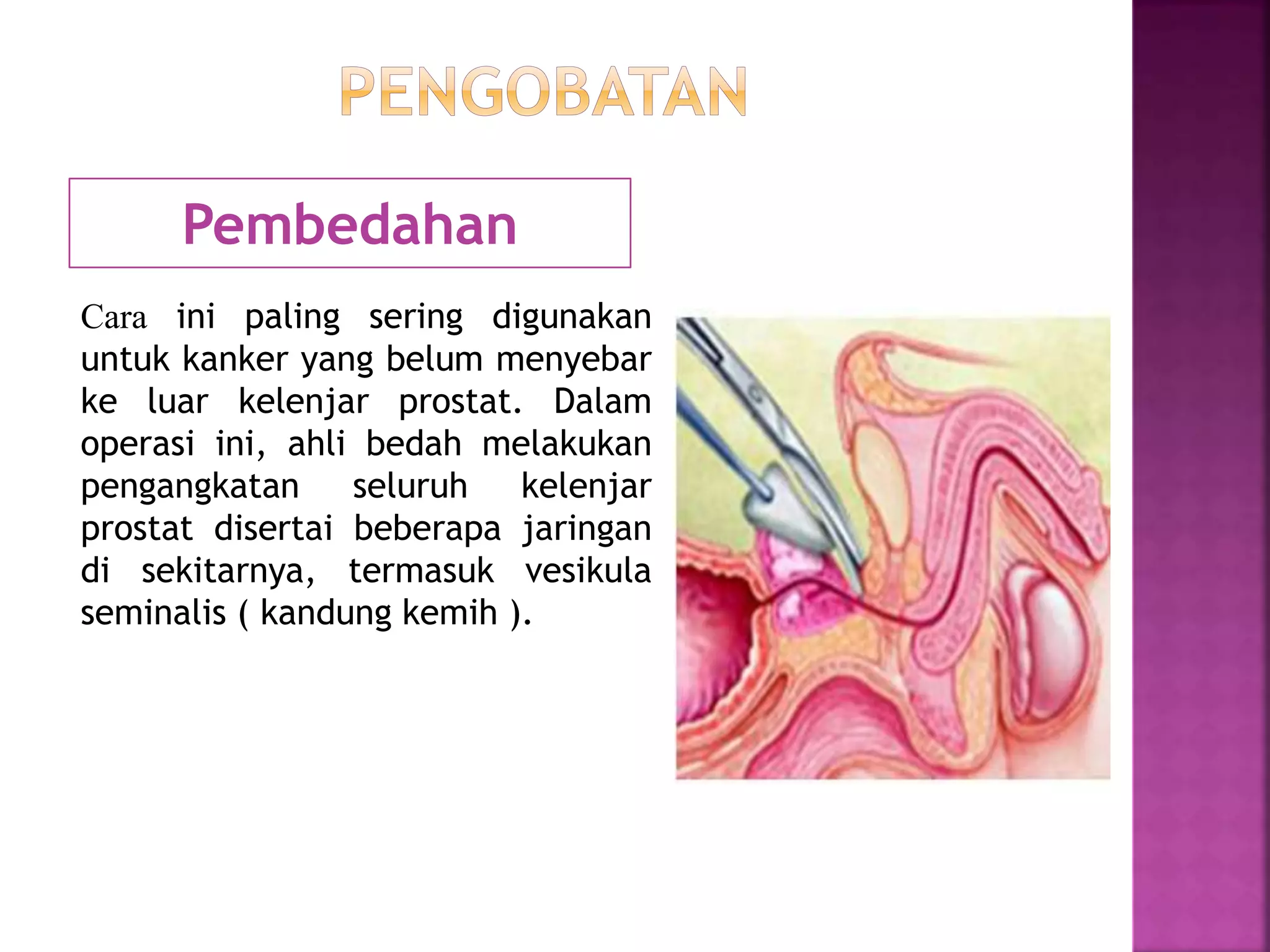 Kanker prostat power point | PPTX