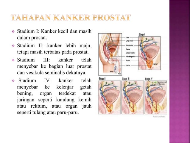 Kanker prostat power point | PPTX