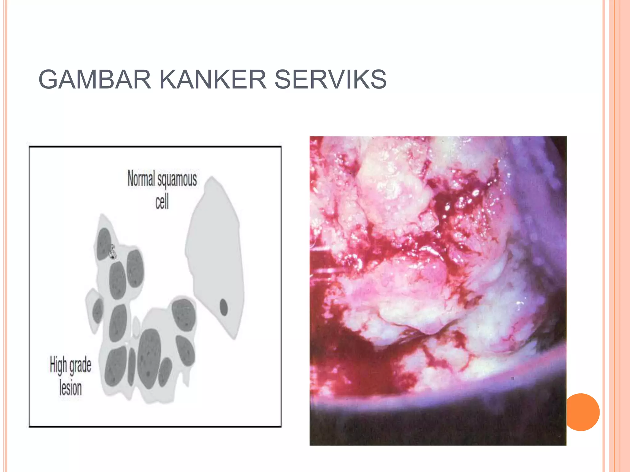 Kanker serviks | PPTX