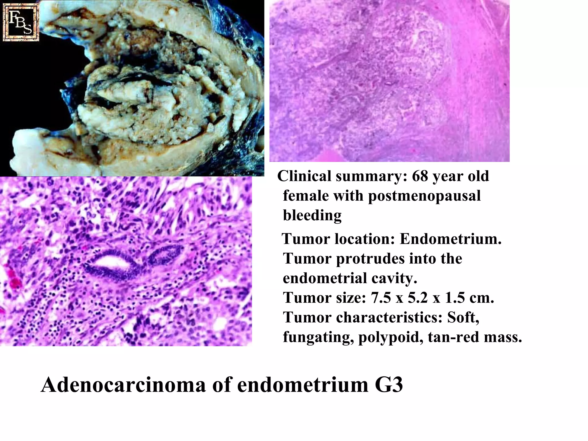 Kanser dan wanita | PPT