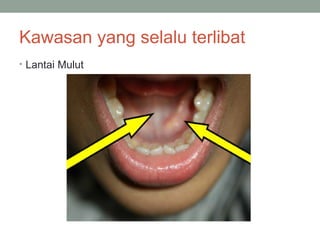 Kanser mulut | PPT