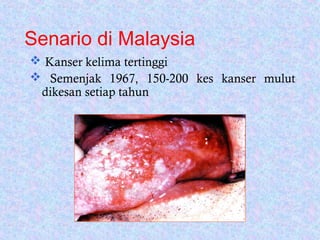 Kanser mulut | PPT