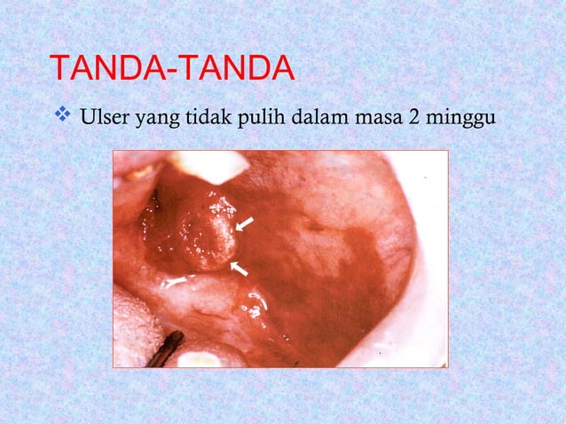 Kanser mulut | PPT