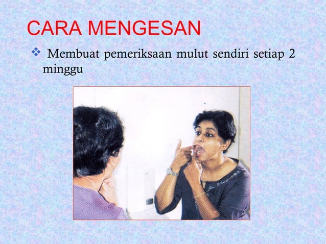 Kanser mulut | PPT