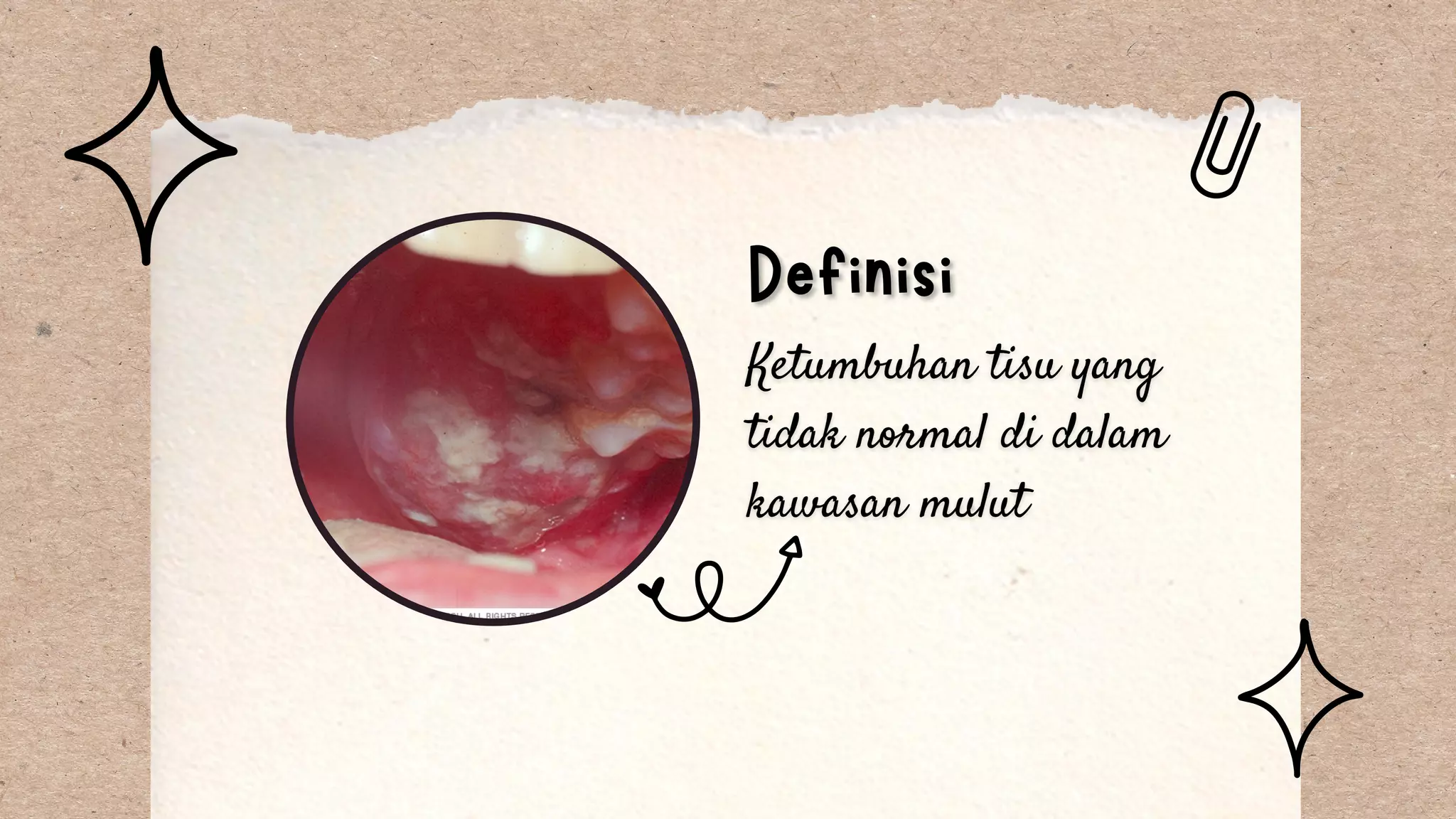 kanser mulut (2).pdf