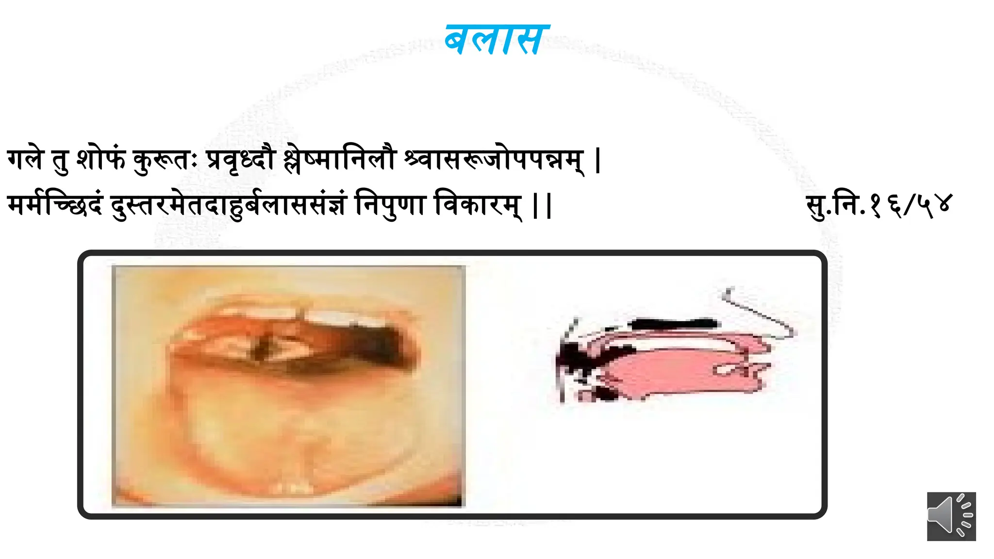 kanthgat rog diagnosis from Ayurvedic aspct | PPTX