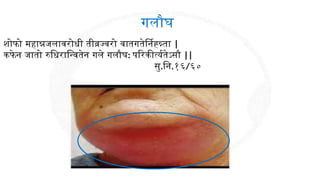 kanthgat rog diagnosis from Ayurvedic aspct | PPT