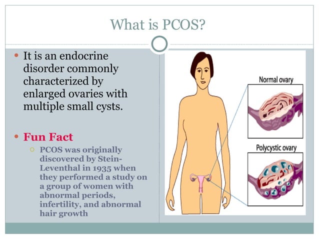 Student Work - PCOS | PPT