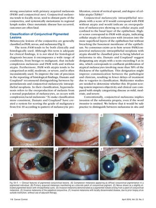 kao-et-al-2016-management-of-primary-acquired-melanosis-nevus-and ...