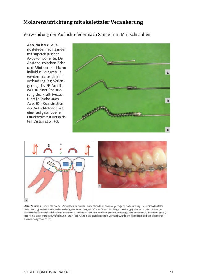 Kapitel 5 Einzelzahnbewegungen. Aufrichten von Molaren