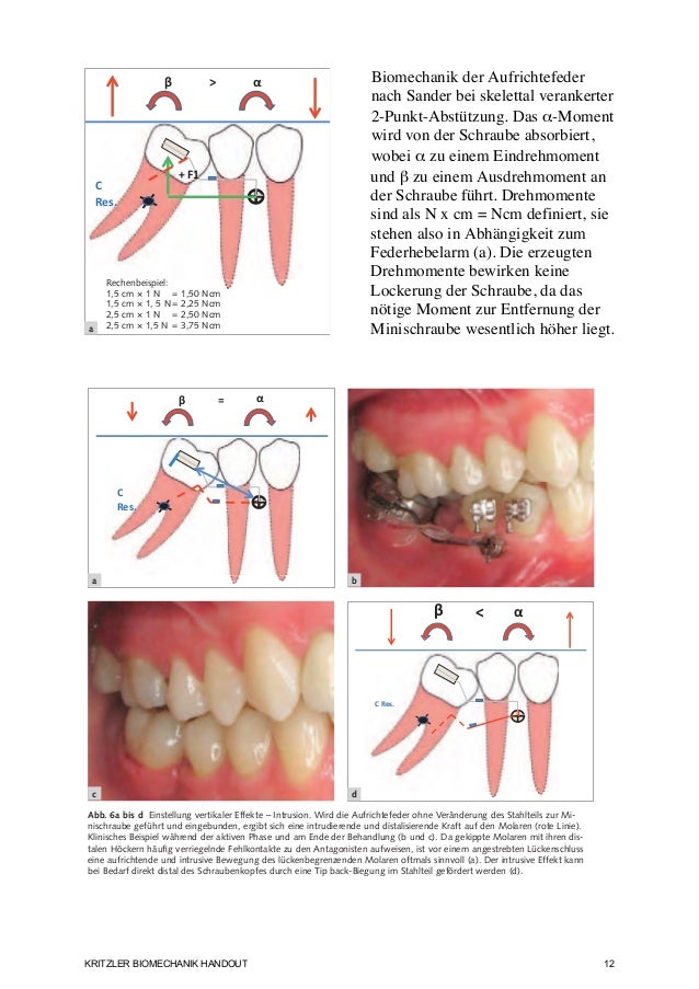 Kapitel 5 Einzelzahnbewegungen. Aufrichten von Molaren