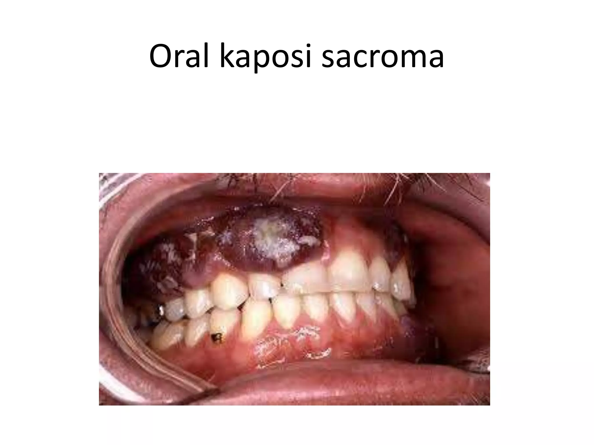 Kaposi sarcoma | PPTX