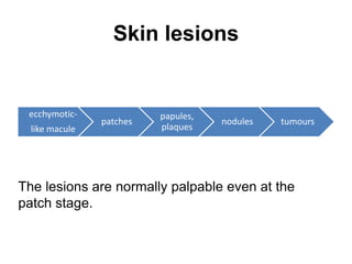 Kaposi sarcoma | PPTX