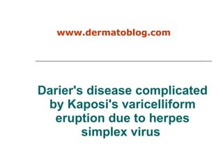 Kaposi variceliform erupcion | PPT | Skin and Dermatology | Diseases ...