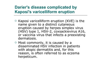Kaposi variceliform erupcion | PPT | Skin and Dermatology | Diseases ...