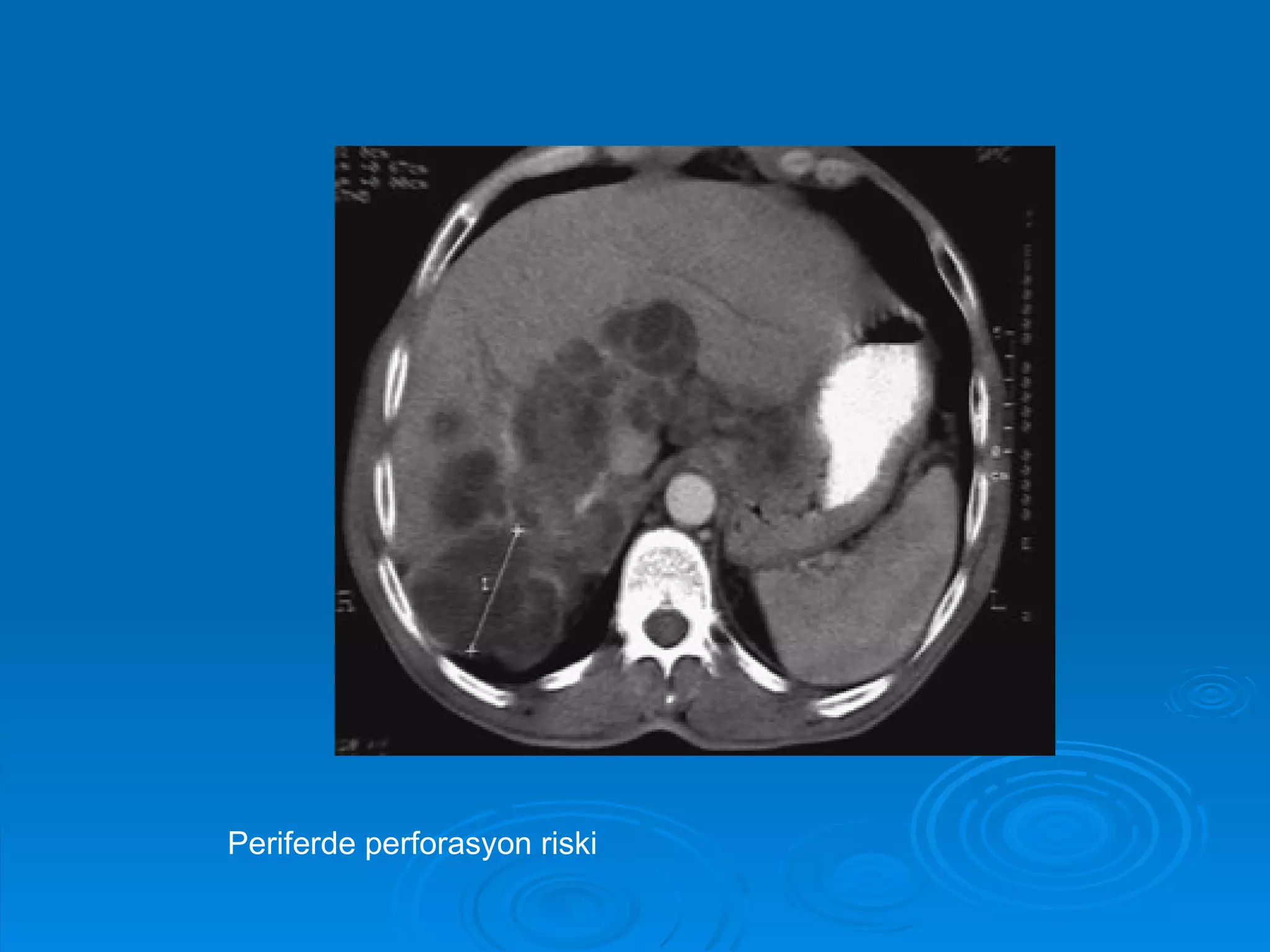 Karaciğer kist hidatid, karaciğer abseleri, amib absesi | PPT