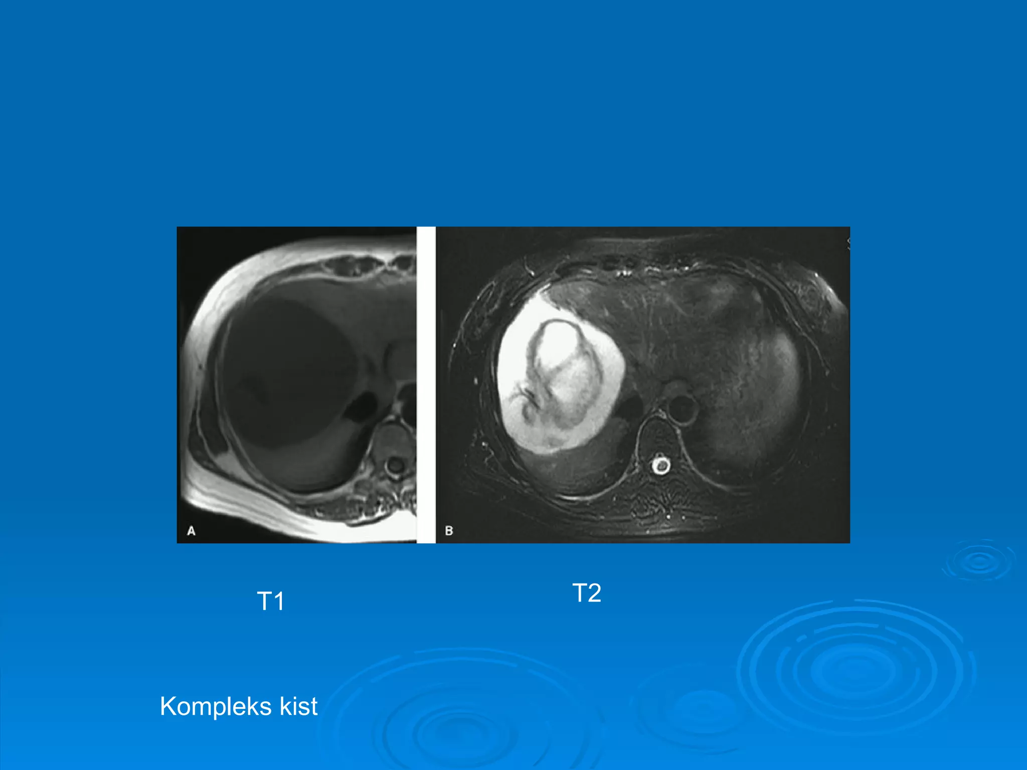 Karaciğer kist hidatid, karaciğer abseleri, amib absesi | PPT