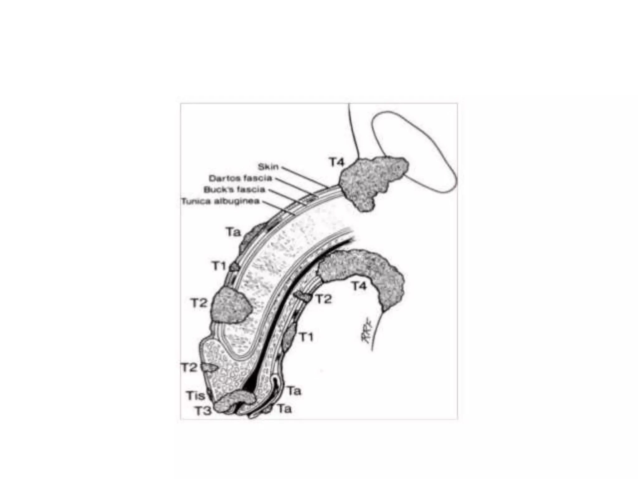 penile cancer CA PENIS | PPTX | Cancer | Diseases and Conditions