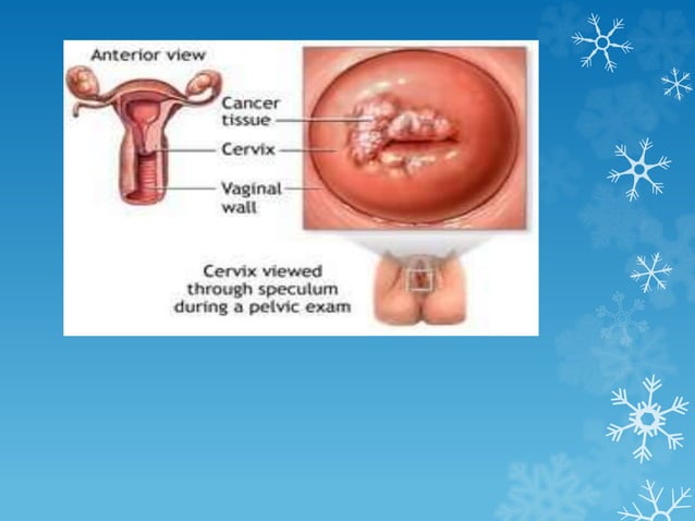 Karcinom grlica i tijela materice | PPT