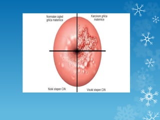 Karcinom grlica i tijela materice | PPTX