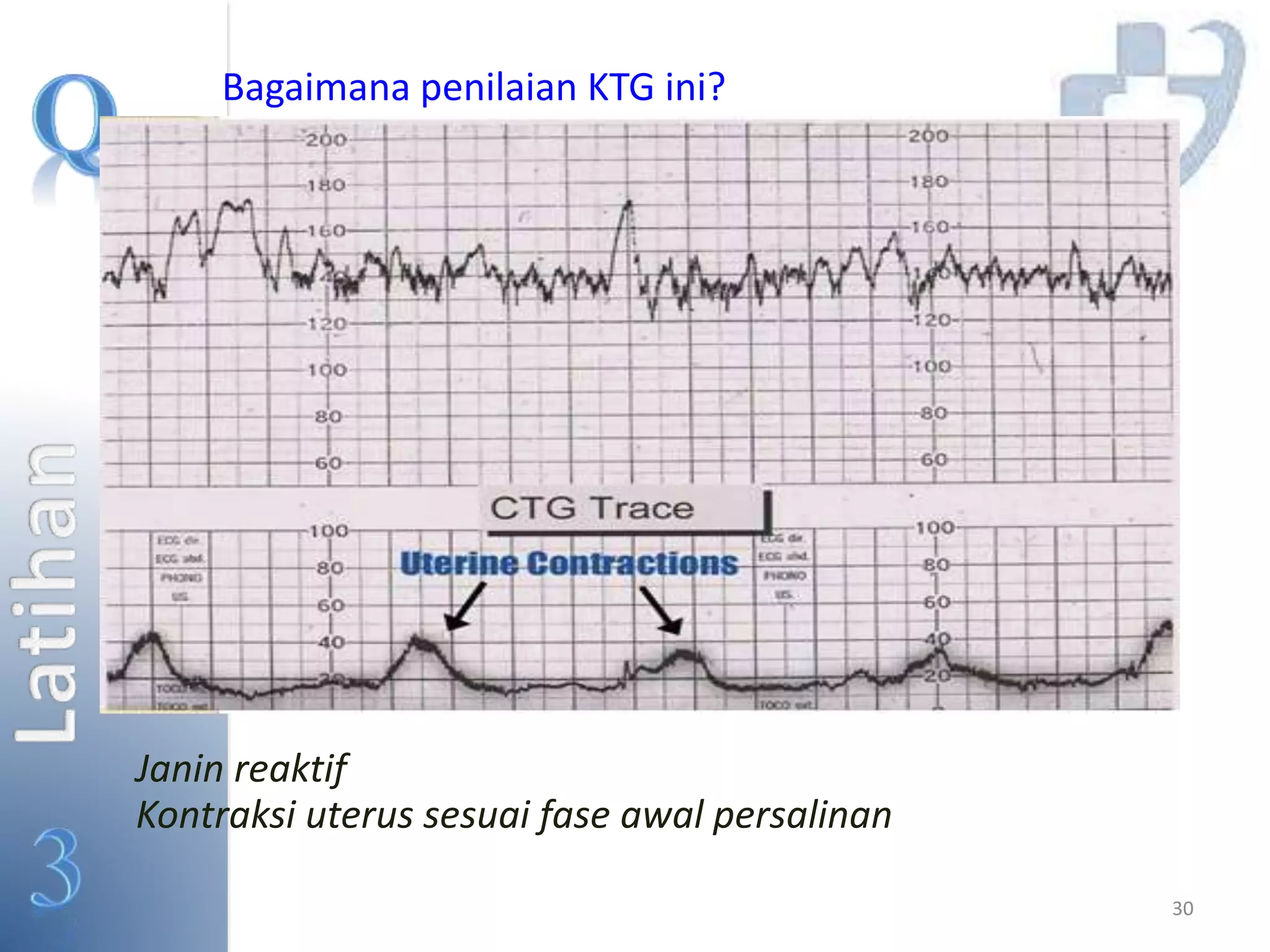 Kardiotokografi | PPTX