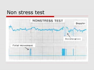 Kardiotokografi | PPT