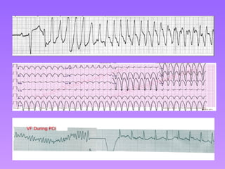 KARDIOVERSI.defibrilasi.kardioversi.defibrilasi | PPTX