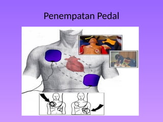 KARDIOVERSI.defibrilasi.kardioversi.defibrilasi | PPTX