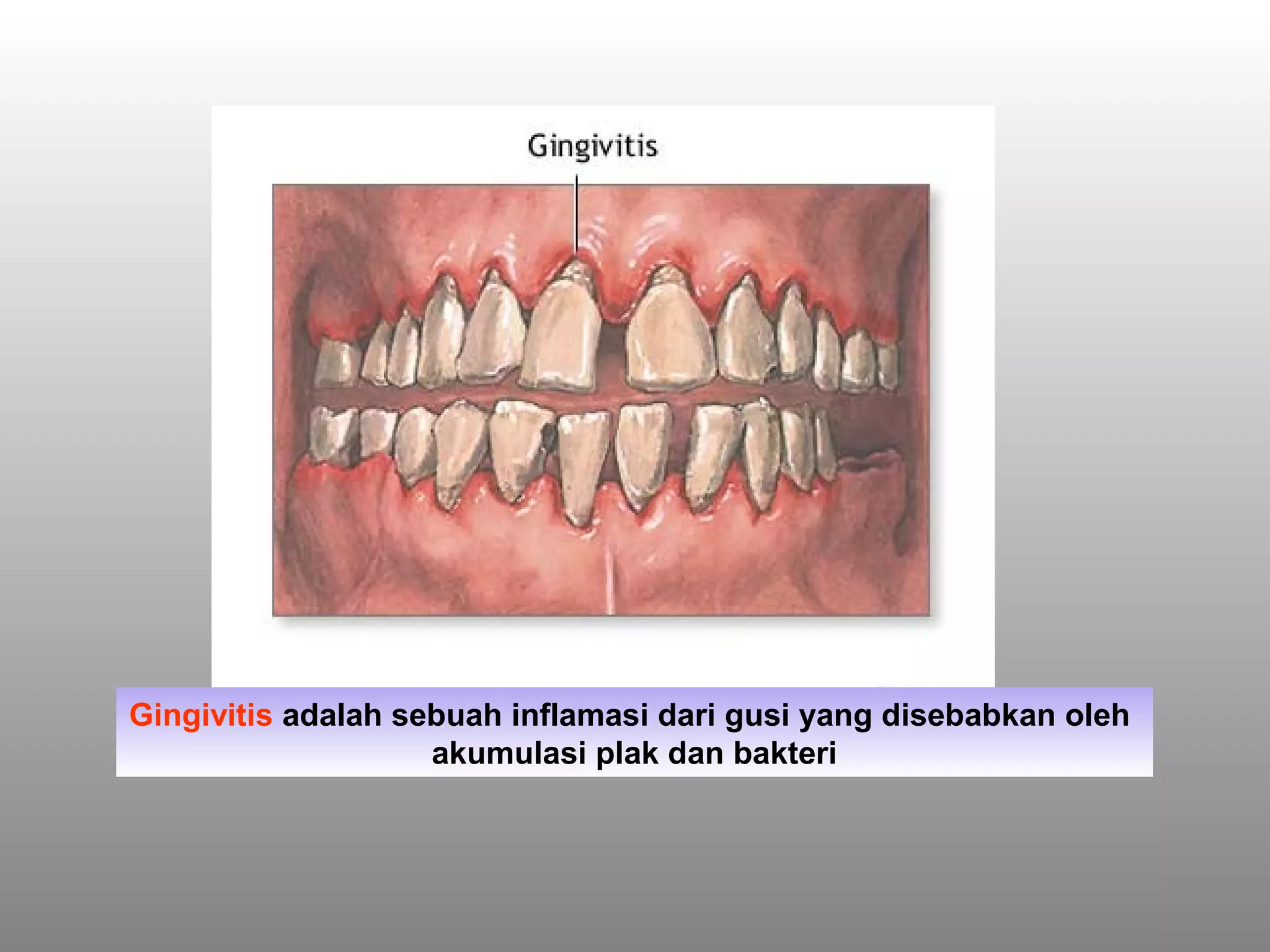 Karies dan gingivitis | PPT