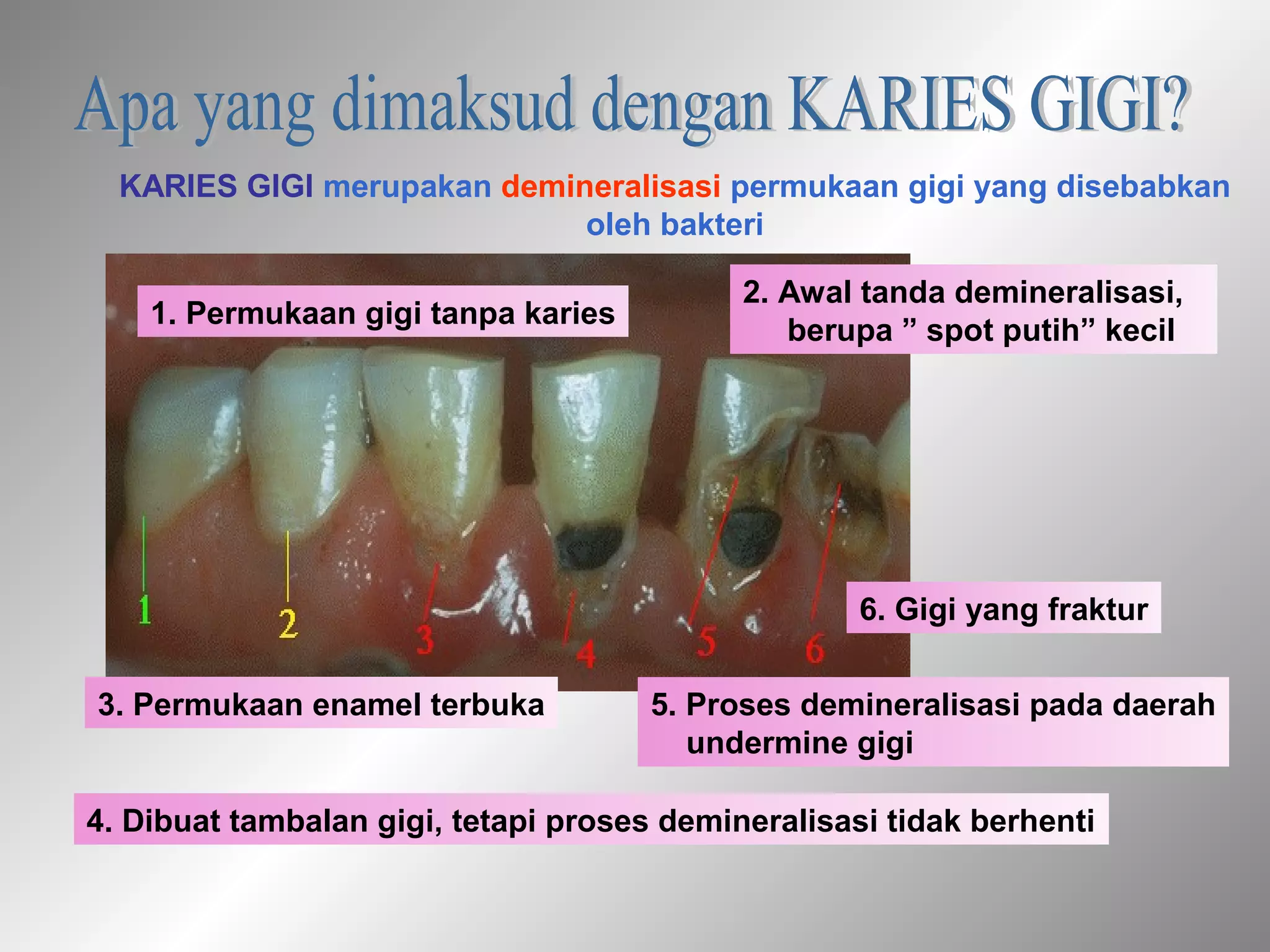 Karies dan gingivitis | PPT