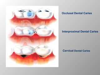 Karies dan gingivitis | PPT