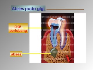 Karies dan gingivitis | PPT
