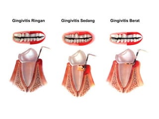 Karies dan gingivitis | PPT