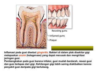Karies dan gingivitis | PPT