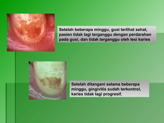 Karies dan gingivitis | PPT